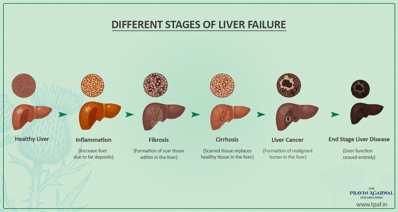 Compensated Cirrhosis