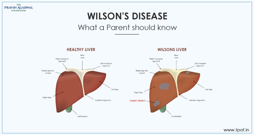 Wilson's Disease: What A Parent Should Know? - TPAF